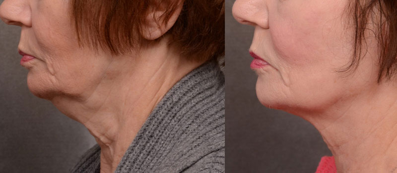 Forma Skin Tightening | Jaja Spa