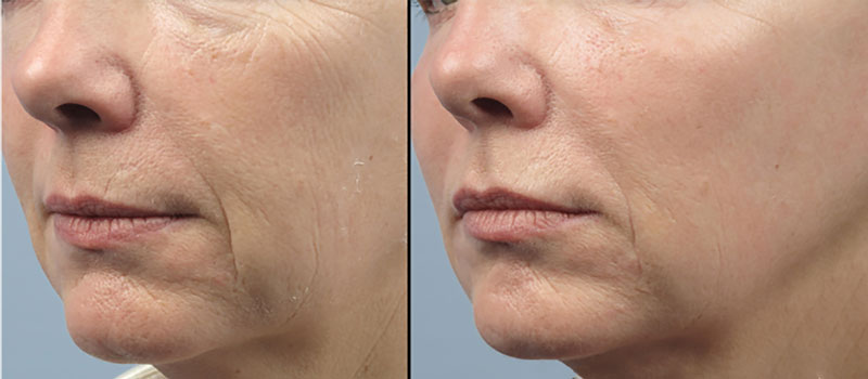 Forma Skin Tightening | Jaja Spa