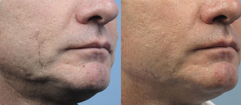 Forma Skin Tightening | Jaja Spa